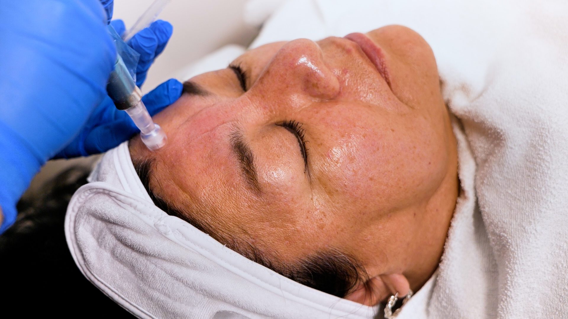 The Best Microneedling & RF North Vancouver